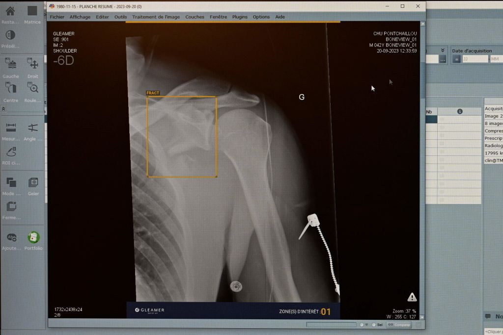 Study Shows Bioengineered Implant Sparks Natural Bone Regeneration ...